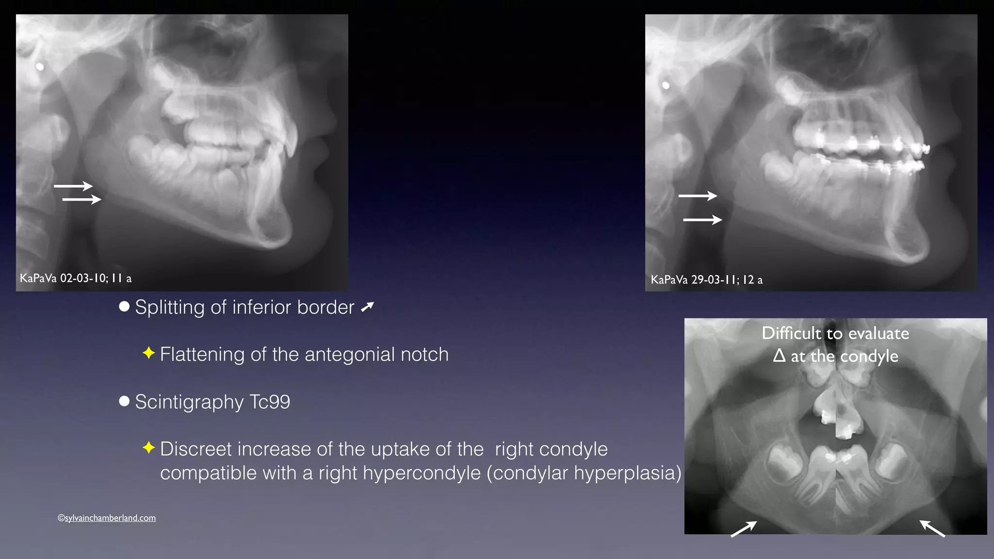 Facial asymmetry condylar hyperplasia or condylar hypoplasia (v a dgkfo ...