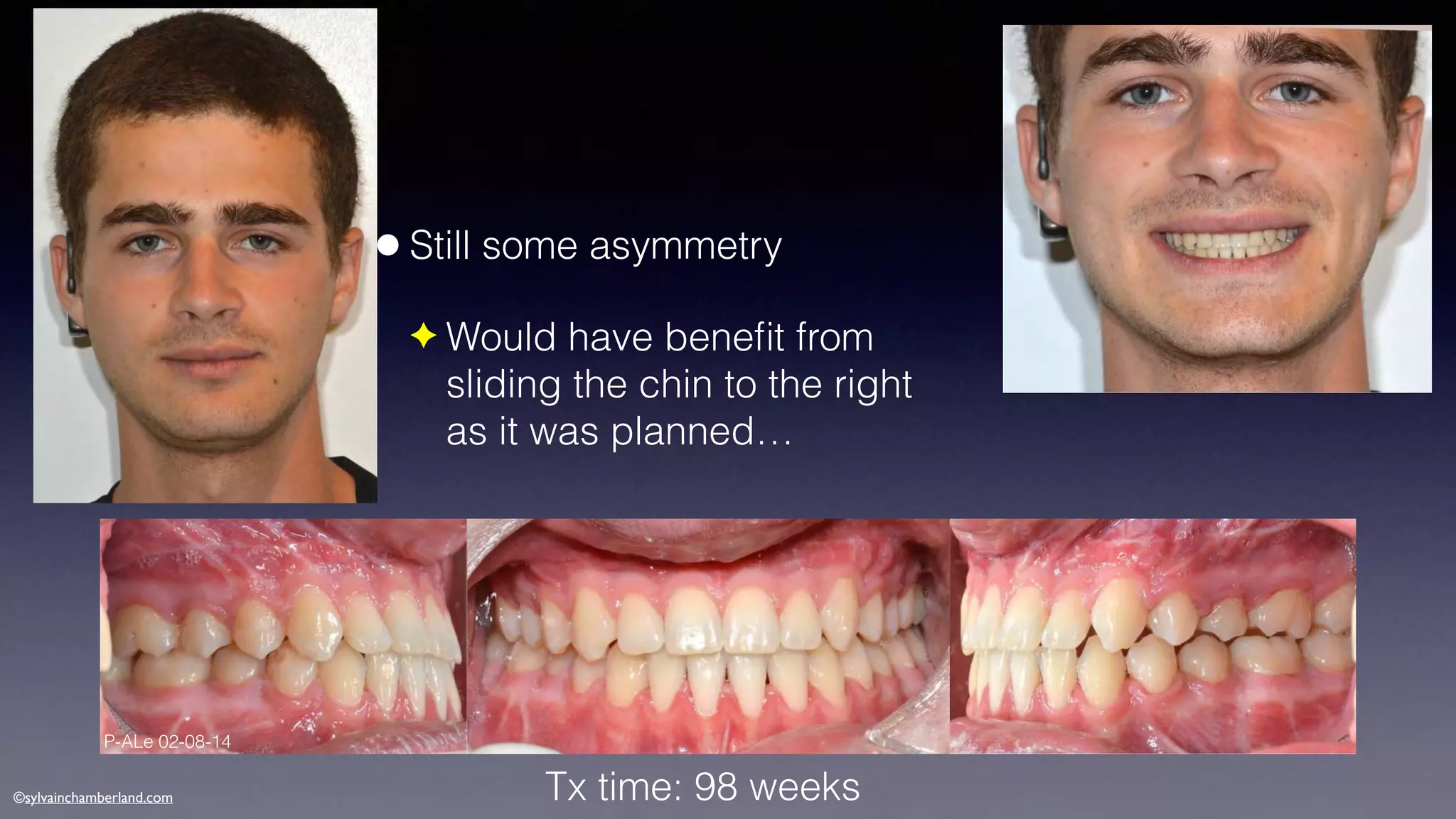 Facial asymmetry condylar hyperplasia or condylar hypoplasia (v a dgkfo ...