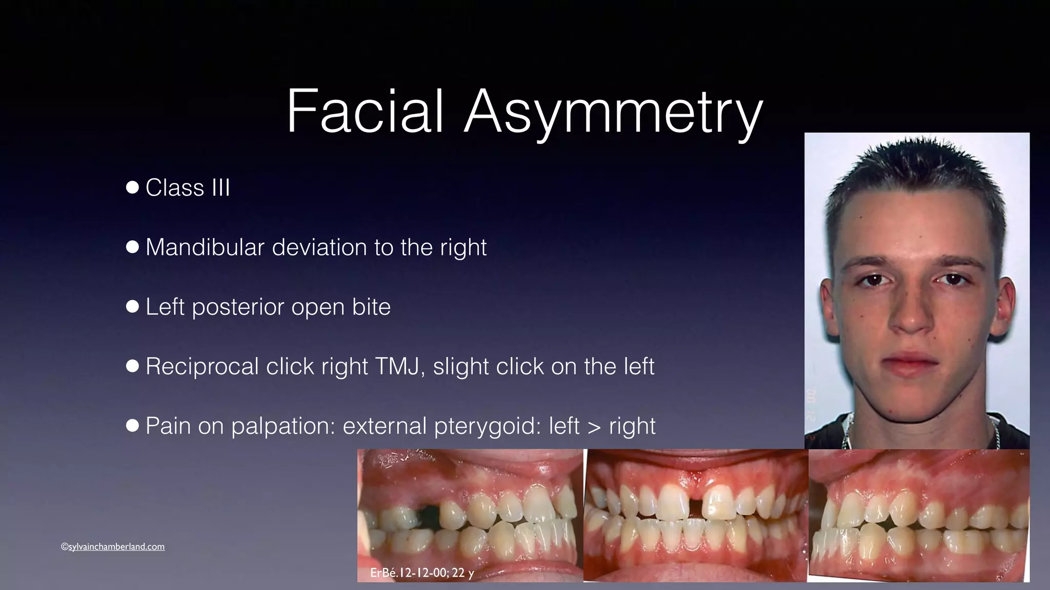 Facial asymmetry condylar hyperplasia or condylar hypoplasia (v a dgkfo ...