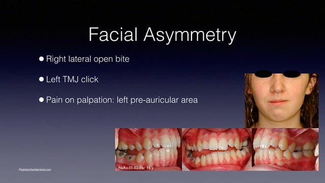 Facial asymmetry condylar hyperplasia or condylar hypoplasia (v a dgkfo ...