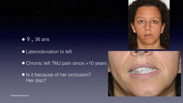 Facial asymmetry condylar hyperplasia or condylar hypoplasia (v a dgkfo ...