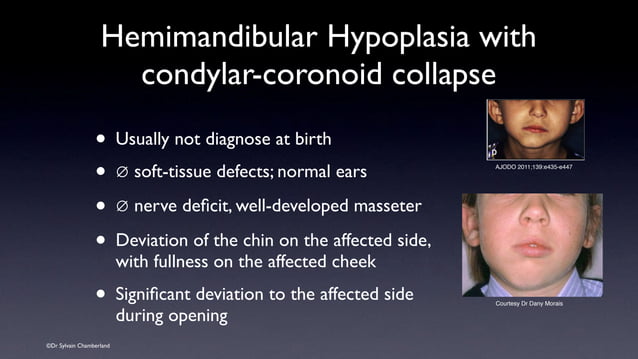 Facial asymmetry condylar hyperplasia or condylar hypoplasia (v a dgkfo ...