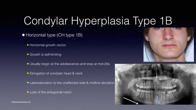 Facial asymmetry condylar hyperplasia or condylar hypoplasia (v a dgkfo ...