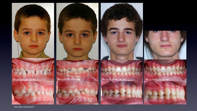Facial asymmetry condylar hyperplasia or condylar hypoplasia (v a dgkfo ...