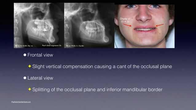 Facial asymmetry condylar hyperplasia or condylar hypoplasia (v a dgkfo ...