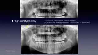Facial asymmetry condylar hyperplasia or condylar hypoplasia (v a dgkfo ...