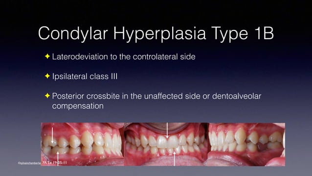 Facial asymmetry condylar hyperplasia or condylar hypoplasia (v a dgkfo ...