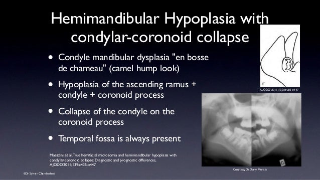 Facial Asymmetry Condylar Hyperplasia Or Condylar Hypoplasia V A Dg