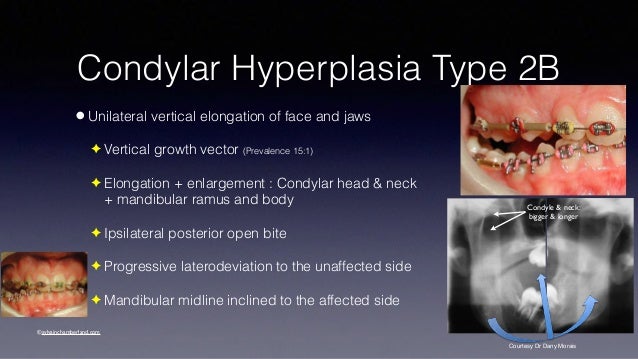 Facial asymmetry condylar hyperplasia or condylar hypoplasia (v a dg…