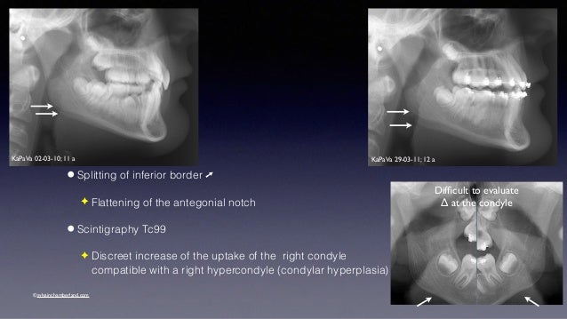 Facial Asymmetry Condylar Hyperplasia Or Condylar Hypoplasia V A Dg