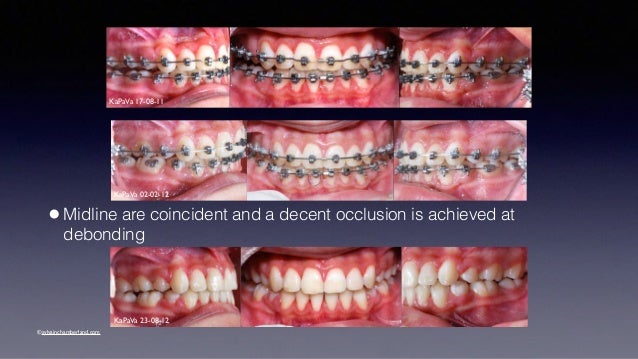 Facial Asymmetry Condylar Hyperplasia Or Condylar Hypoplasia V A Dg