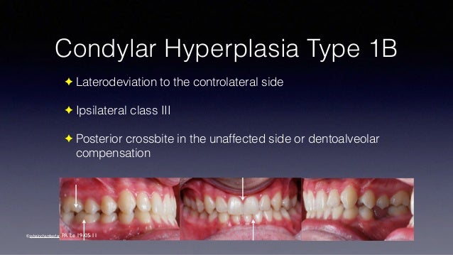 Facial Asymmetry Condylar Hyperplasia Or Condylar Hypoplasia V A Dg