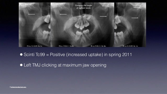 Facial Asymmetry Condylar Hyperplasia Or Condylar Hypoplasia V A Dg