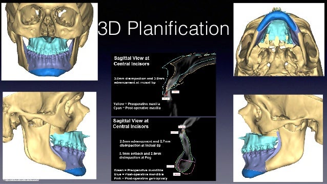 Facial Asymmetry Condylar Hyperplasia Or Condylar Hypoplasia V A Dg