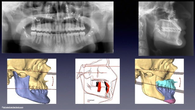Facial Asymmetry Condylar Hyperplasia Or Condylar Hypoplasia V A Dg