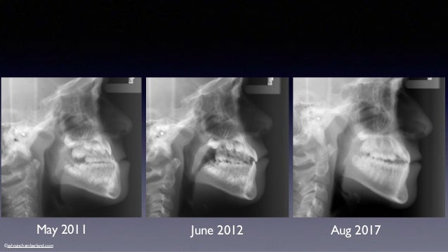 Facial Asymmetry Condylar Hyperplasia Or Condylar Hypoplasia V A Dg