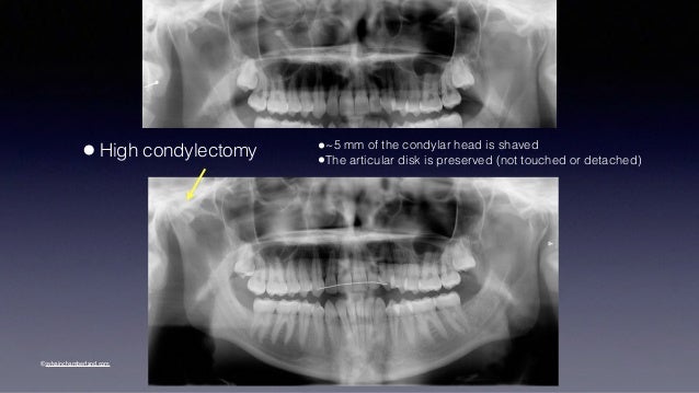 Facial Asymmetry Condylar Hyperplasia Or Condylar Hypoplasia V A Dg