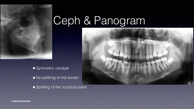 Facial Asymmetry Condylar Hyperplasia Or Condylar Hypoplasia V A Dg