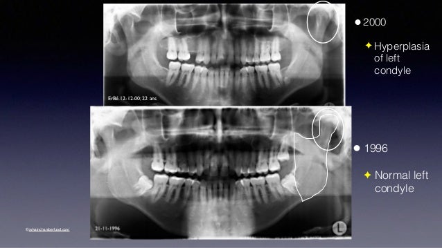 Facial Asymmetry Condylar Hyperplasia Or Condylar Hypoplasia V A Dg