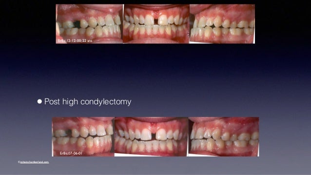 Facial Asymmetry Condylar Hyperplasia Or Condylar Hypoplasia V A Dg