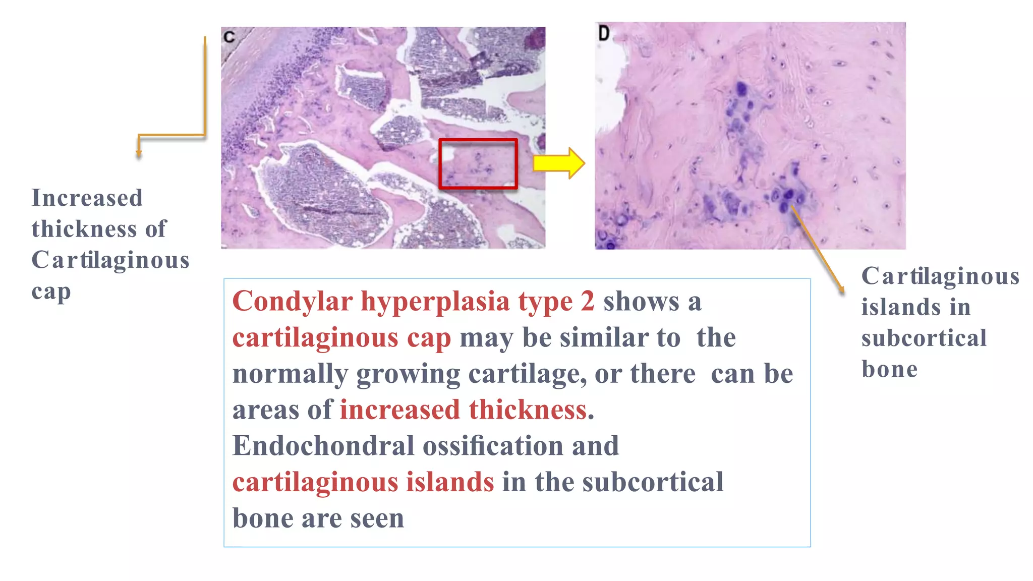 Facial asymmetry condylar hyperplasia and hemifacial microsomia | PPTX