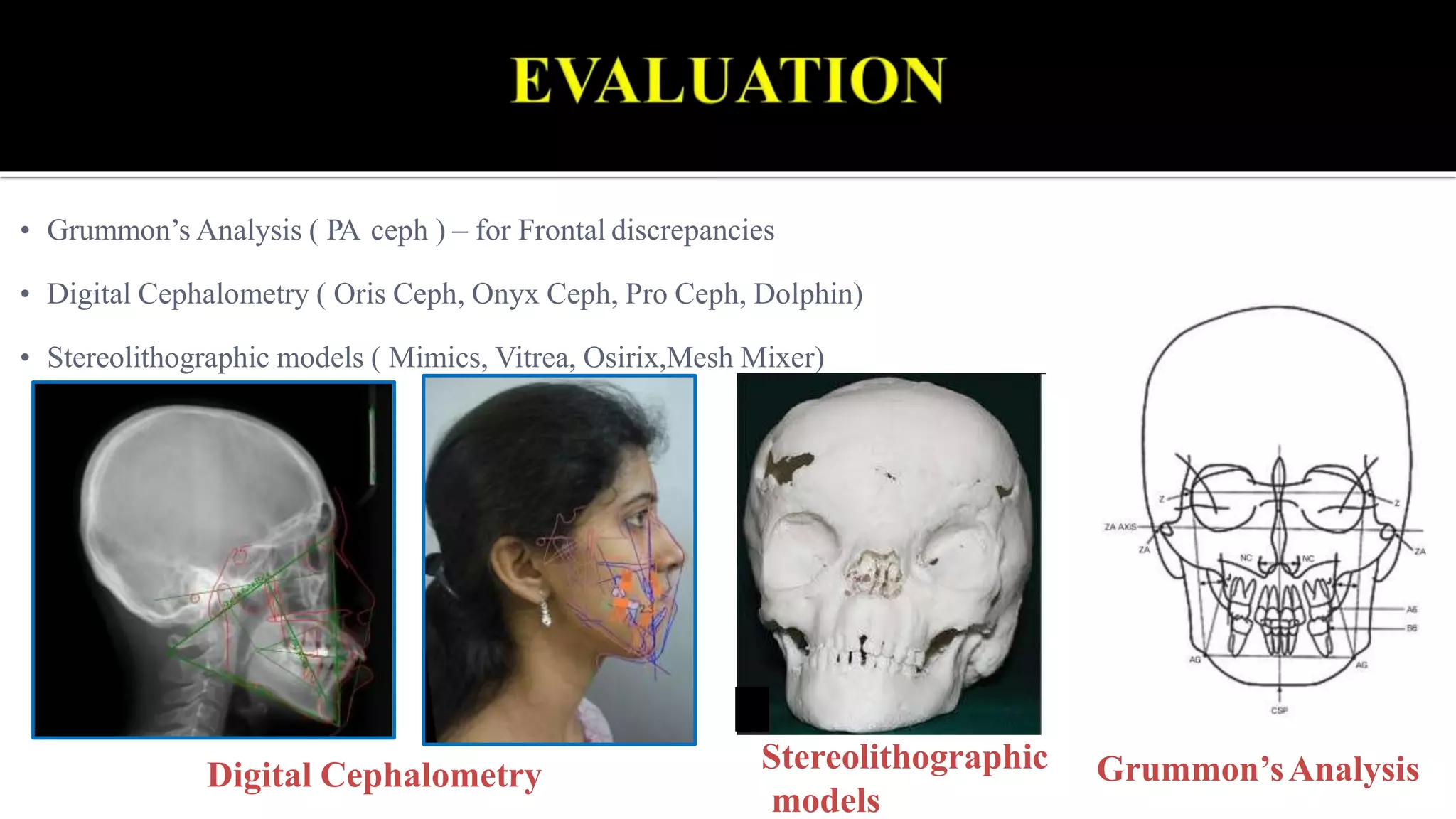Facial asymmetry condylar hyperplasia and hemifacial microsomia | PPTX