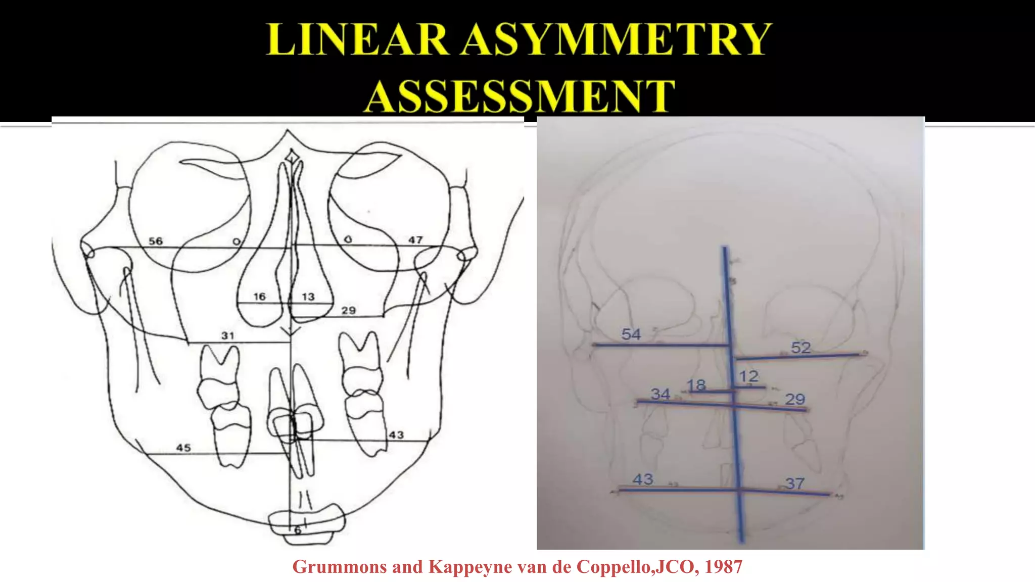 Facial asymmetry condylar hyperplasia and hemifacial microsomia | PPTX