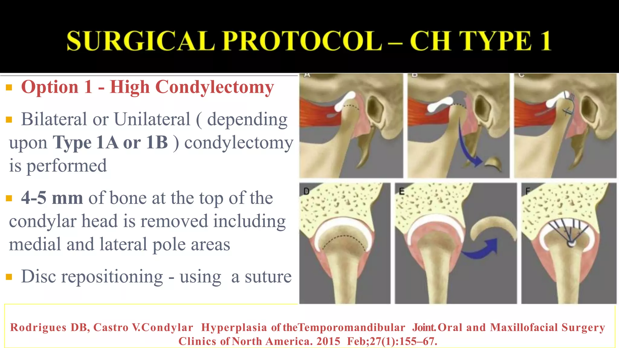 Facial asymmetry condylar hyperplasia and hemifacial microsomia | PPTX
