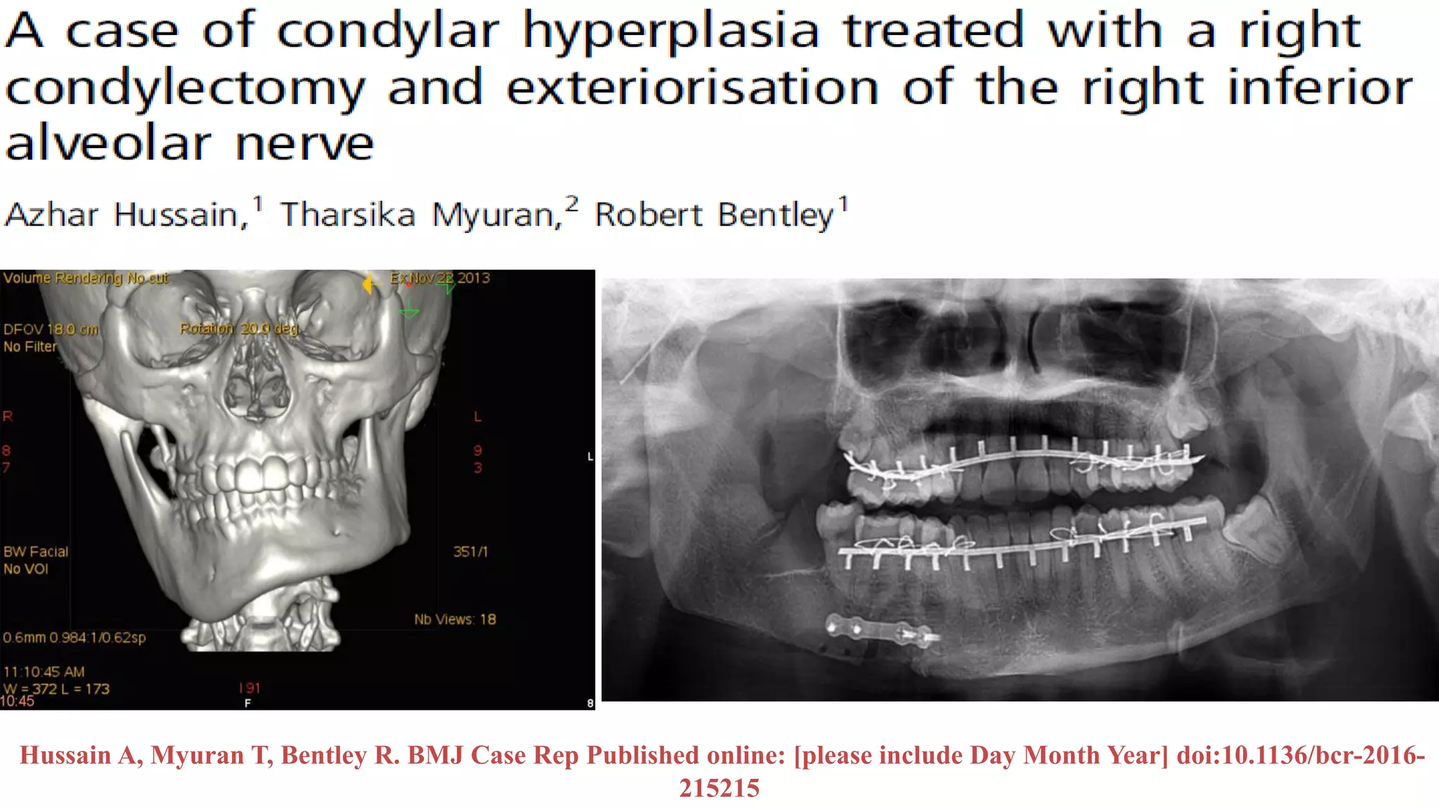 Facial asymmetry condylar hyperplasia and hemifacial microsomia | PPTX