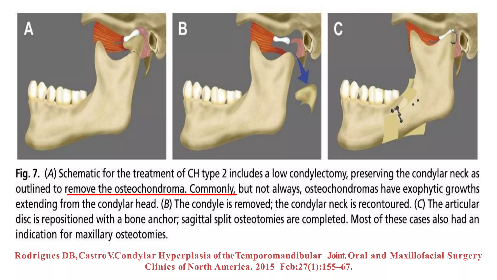 Facial asymmetry condylar hyperplasia and hemifacial microsomia | PPTX