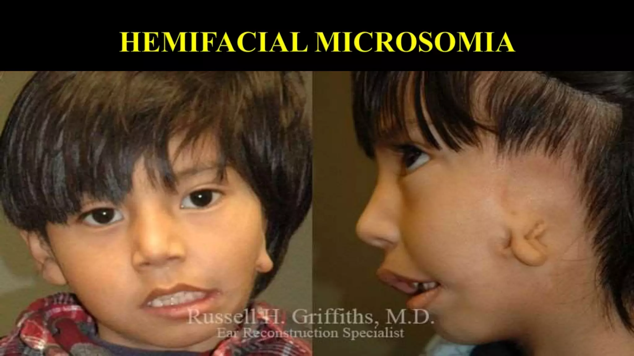 Facial asymmetry condylar hyperplasia and hemifacial microsomia | PPTX ...