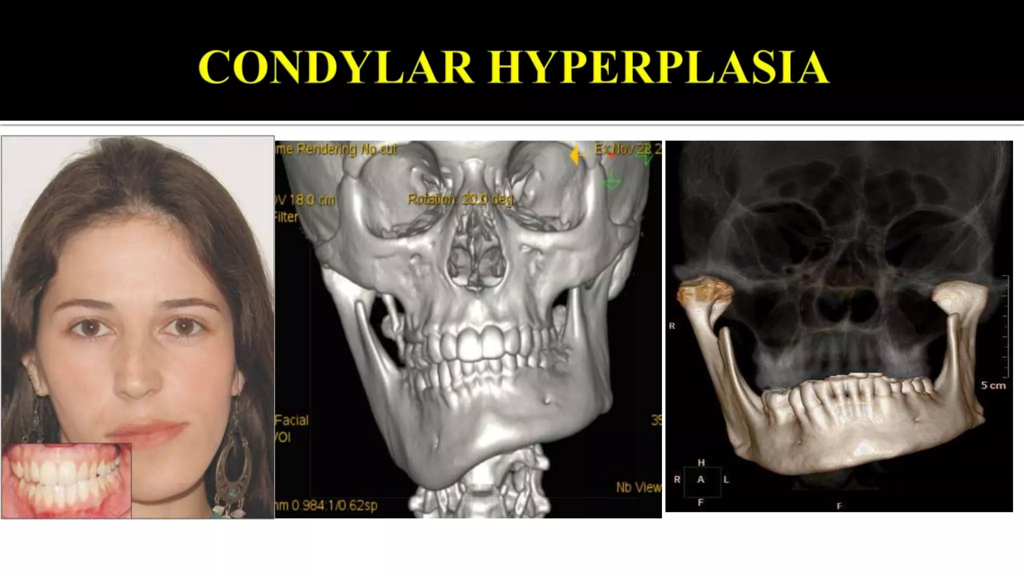 Facial asymmetry condylar hyperplasia and hemifacial microsomia | PPTX