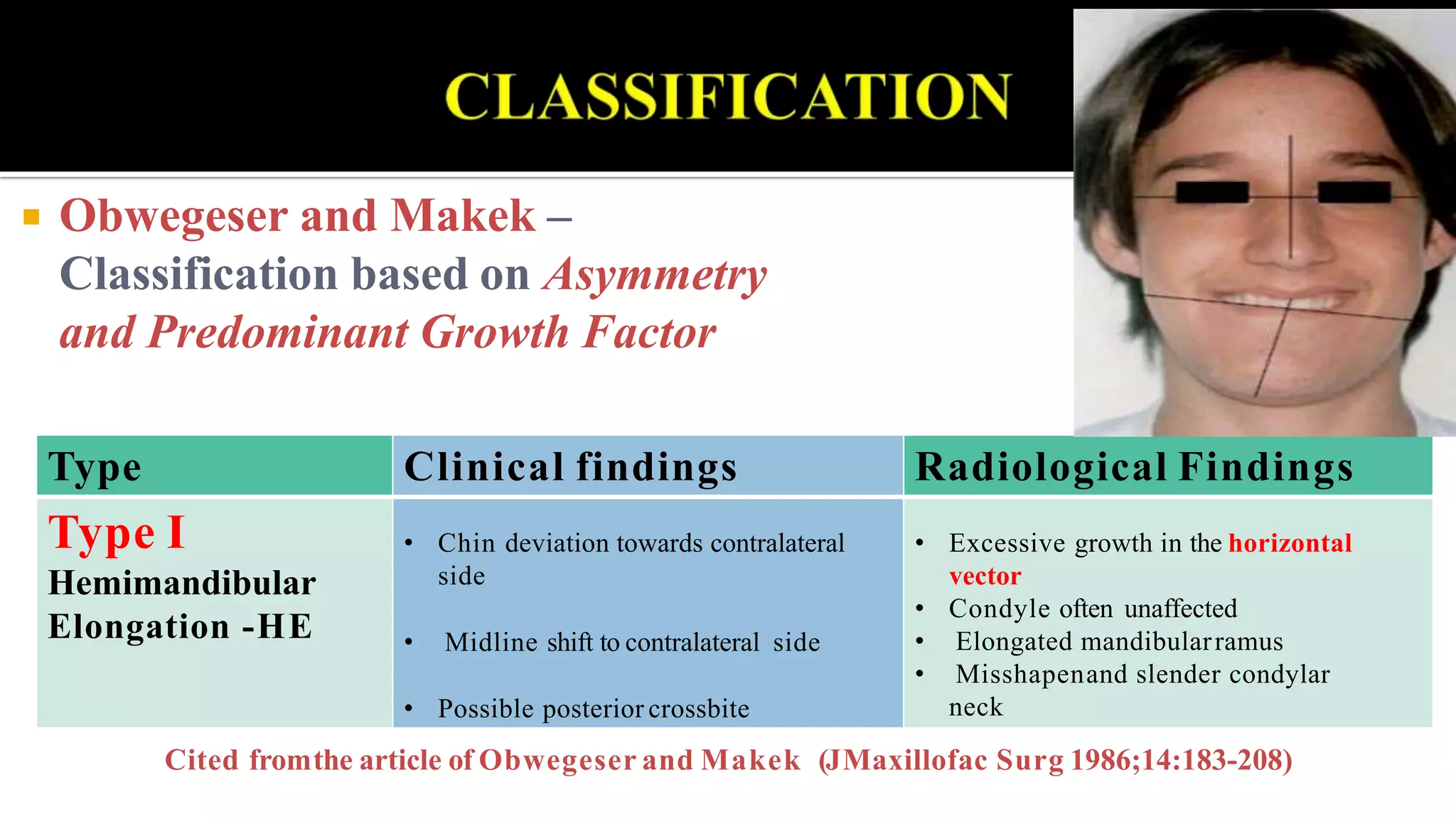 Facial asymmetry condylar hyperplasia and hemifacial microsomia | PPTX