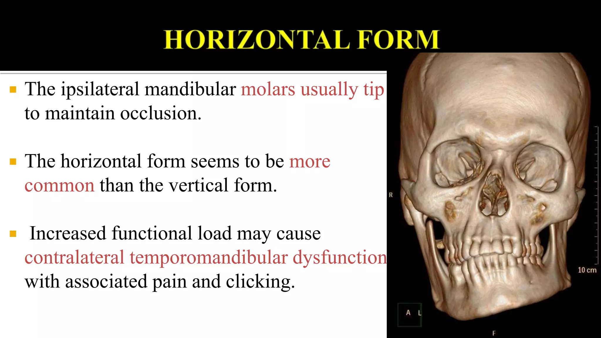 Facial asymmetry condylar hyperplasia and hemifacial microsomia | PPTX