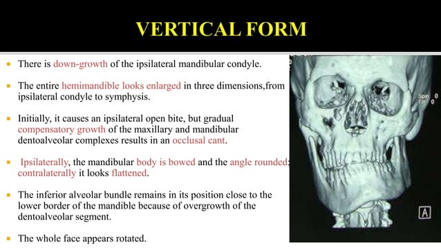 Facial asymmetry condylar hyperplasia and hemifacial microsomia | PPTX ...