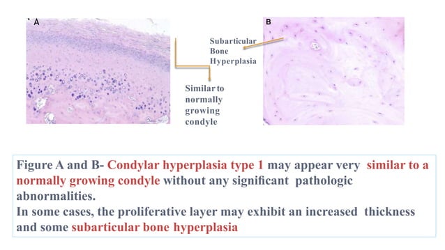 Facial asymmetry condylar hyperplasia and hemifacial microsomia | PPTX ...