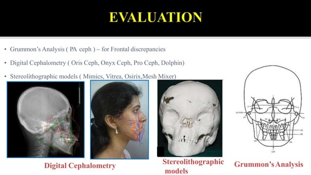Facial asymmetry condylar hyperplasia and hemifacial microsomia | PPTX ...