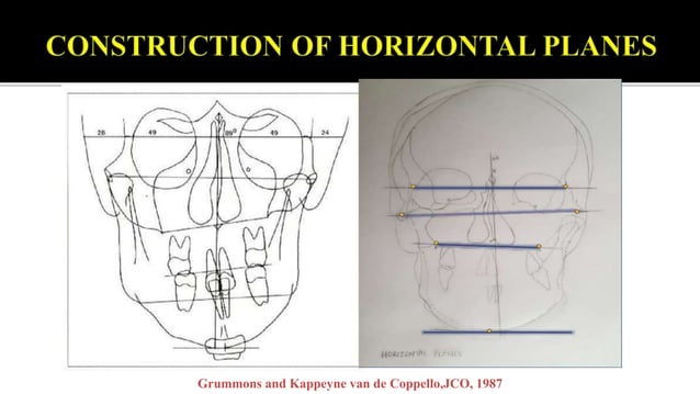 Facial asymmetry condylar hyperplasia and hemifacial microsomia | PPTX ...