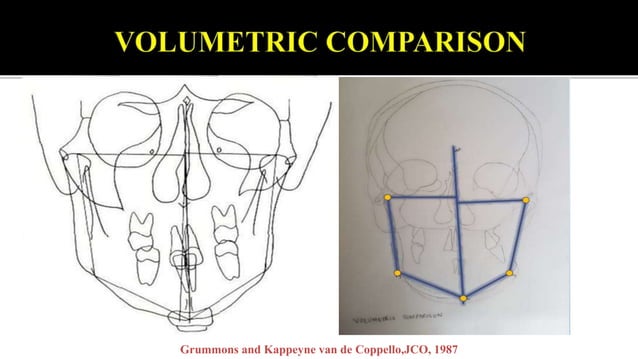 Facial asymmetry condylar hyperplasia and hemifacial microsomia | PPTX ...