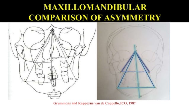 Facial asymmetry condylar hyperplasia and hemifacial microsomia | PPTX ...
