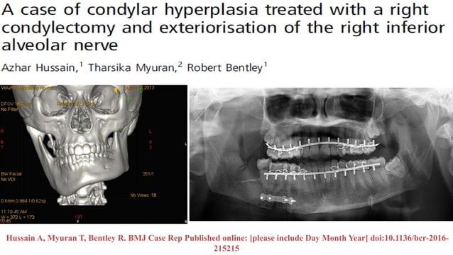 Facial asymmetry condylar hyperplasia and hemifacial microsomia | PPTX ...