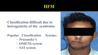 Facial asymmetry condylar hyperplasia and hemifacial microsomia | PPTX