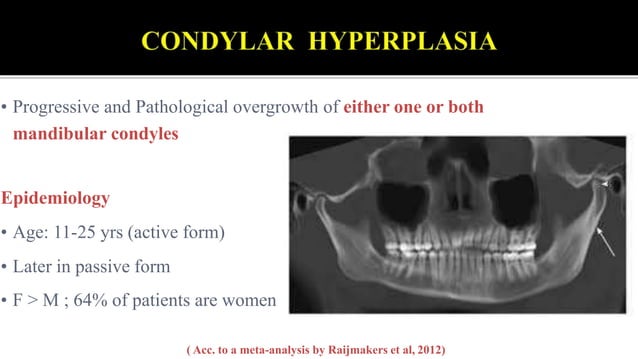 Facial asymmetry condylar hyperplasia and hemifacial microsomia | PPTX ...