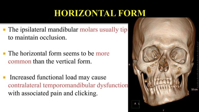 Facial asymmetry condylar hyperplasia and hemifacial microsomia | PPTX ...