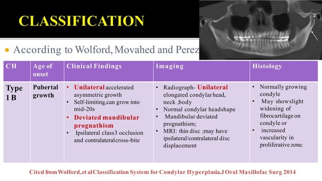 Facial Asymmetry Condylar Hyperplasia And Hemifacial Microsomia