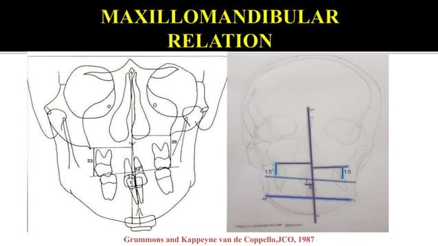Facial Asymmetry Condylar Hyperplasia And Hemifacial Microsomia