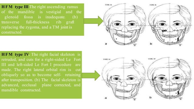 Facial Asymmetry Condylar Hyperplasia And Hemifacial Microsomia
