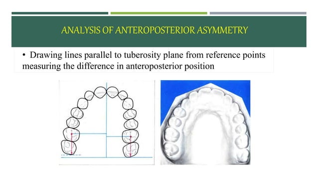 facial asymmetry ppt management in orthodontics .pptx | Dental Health ...