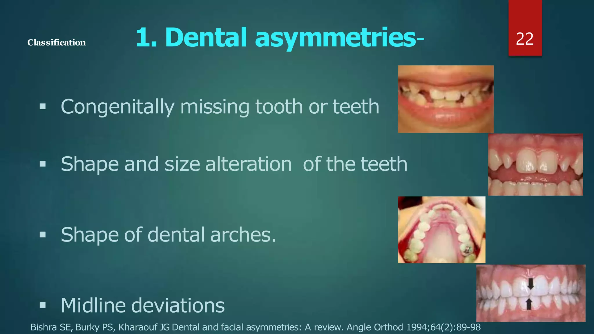Facial Asymmetry | PPTX