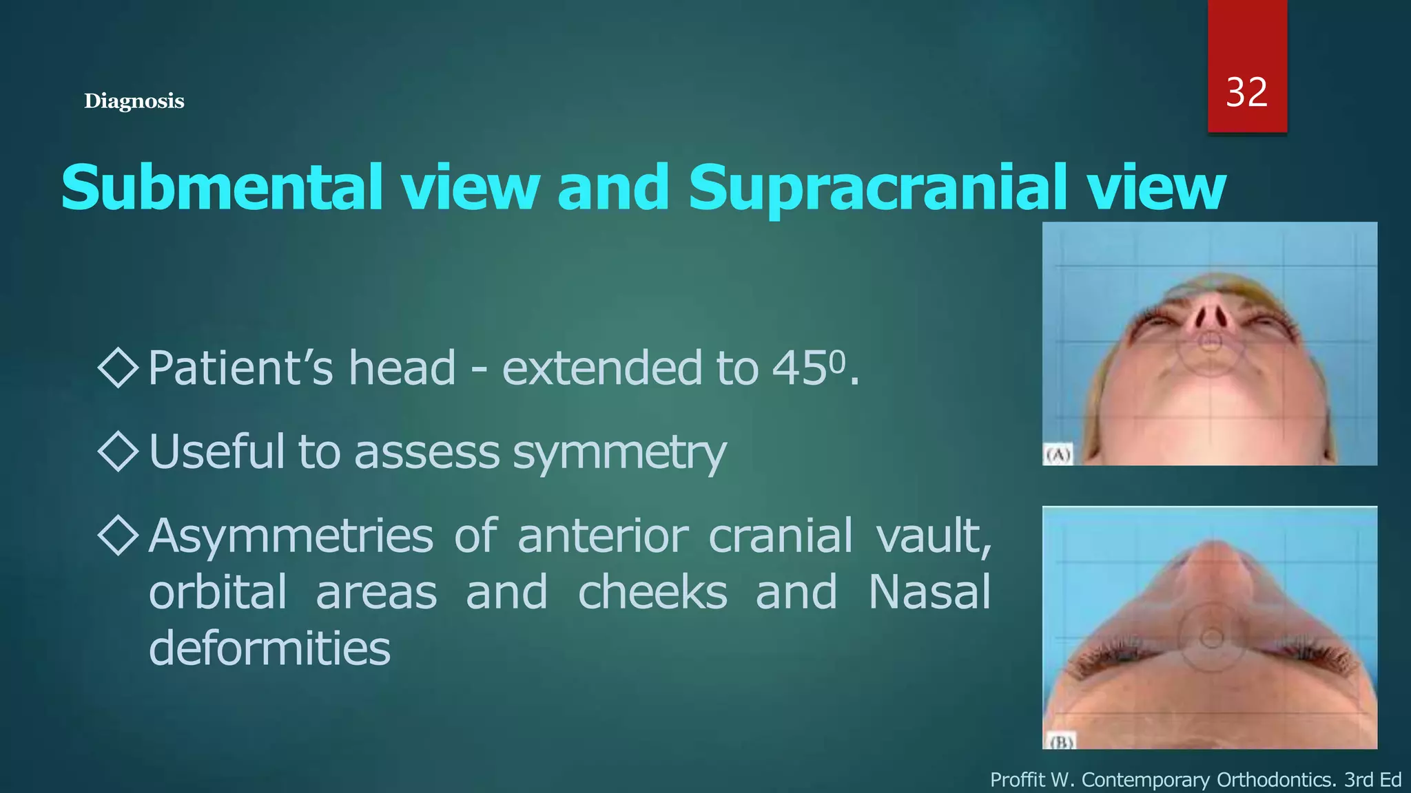 Facial Asymmetry | PPTX